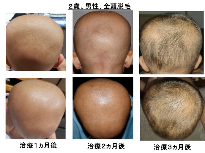 全頭脱毛の2歳男子患者様、治療3ヵ月で、急速改善！！ 患者様からの声・メディア掲載・クリニックからのお知らせ 名古屋kクリニック
